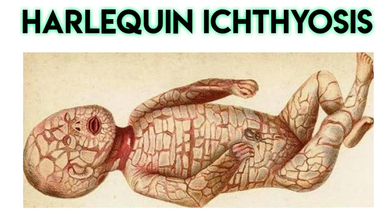 Harlequin Ichthyosis Youtube