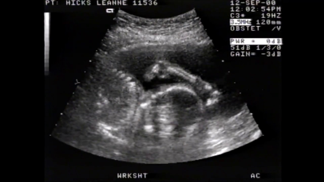 Jack Hicks Ultrasound 12 September 2000 - YouTube