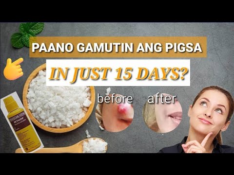 Part3 My Home Remedies/My PigSa Experience(Boil)#janescmix1771 - YouTube
