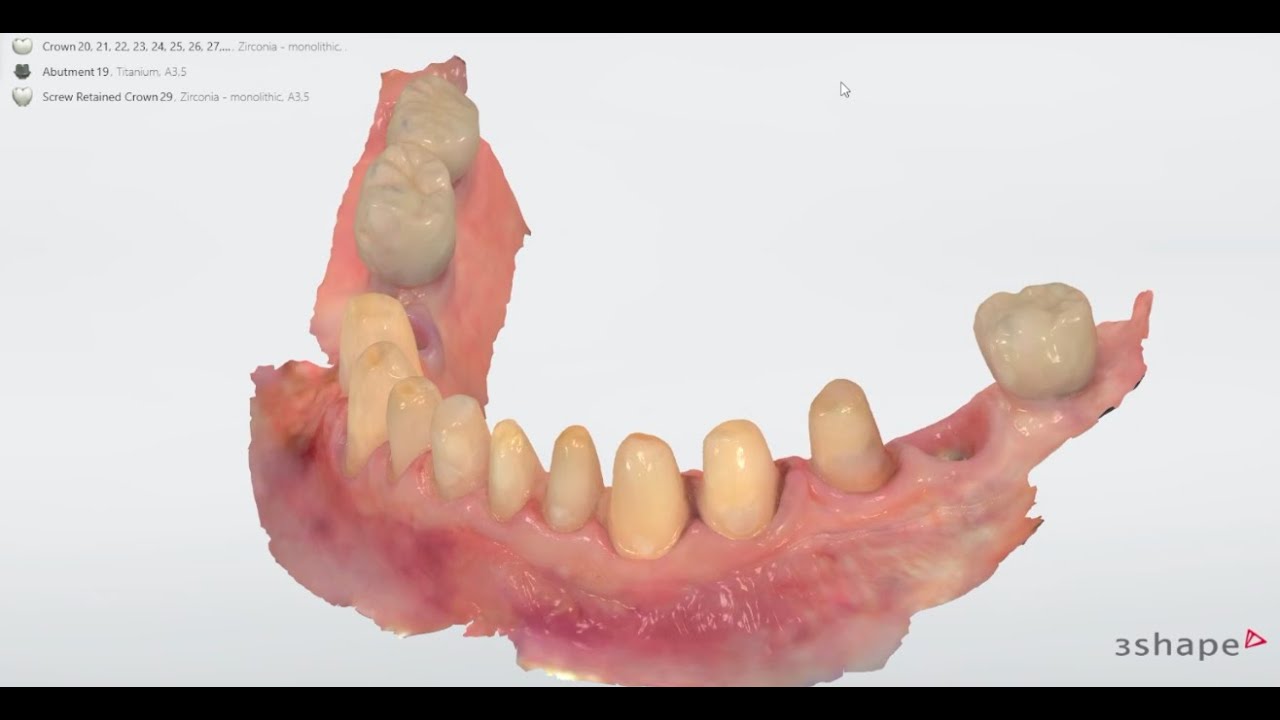 3SHAPE DIGITAL WORKFLOW FULL ZIRCONIA NO MODELS - YouTube