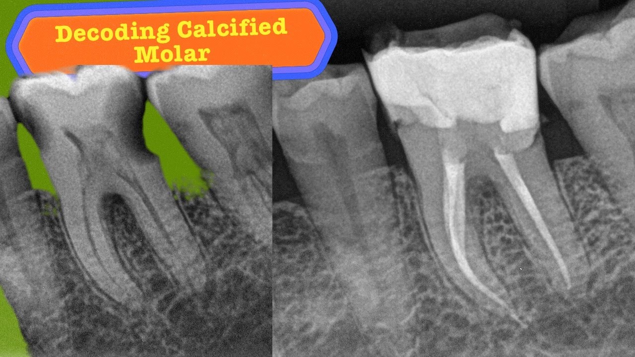 RCT of a Calcified Molar - YouTube