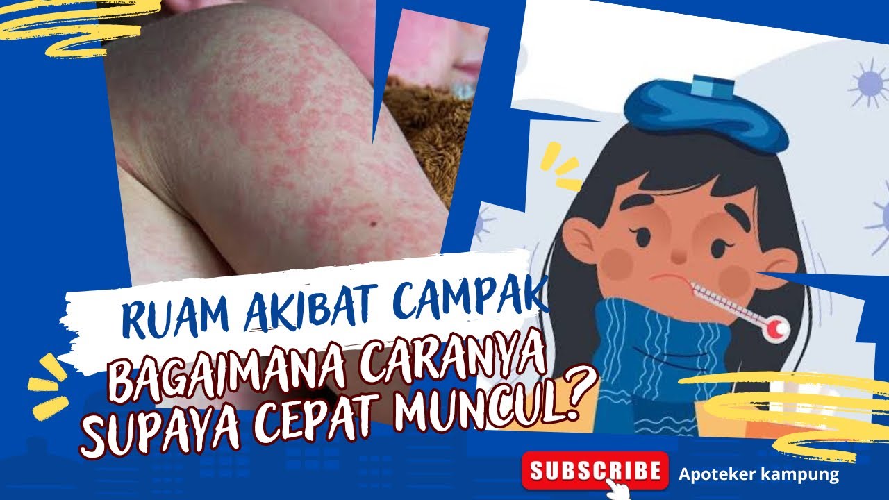 Ruam karena campak belum muncul? - YouTube