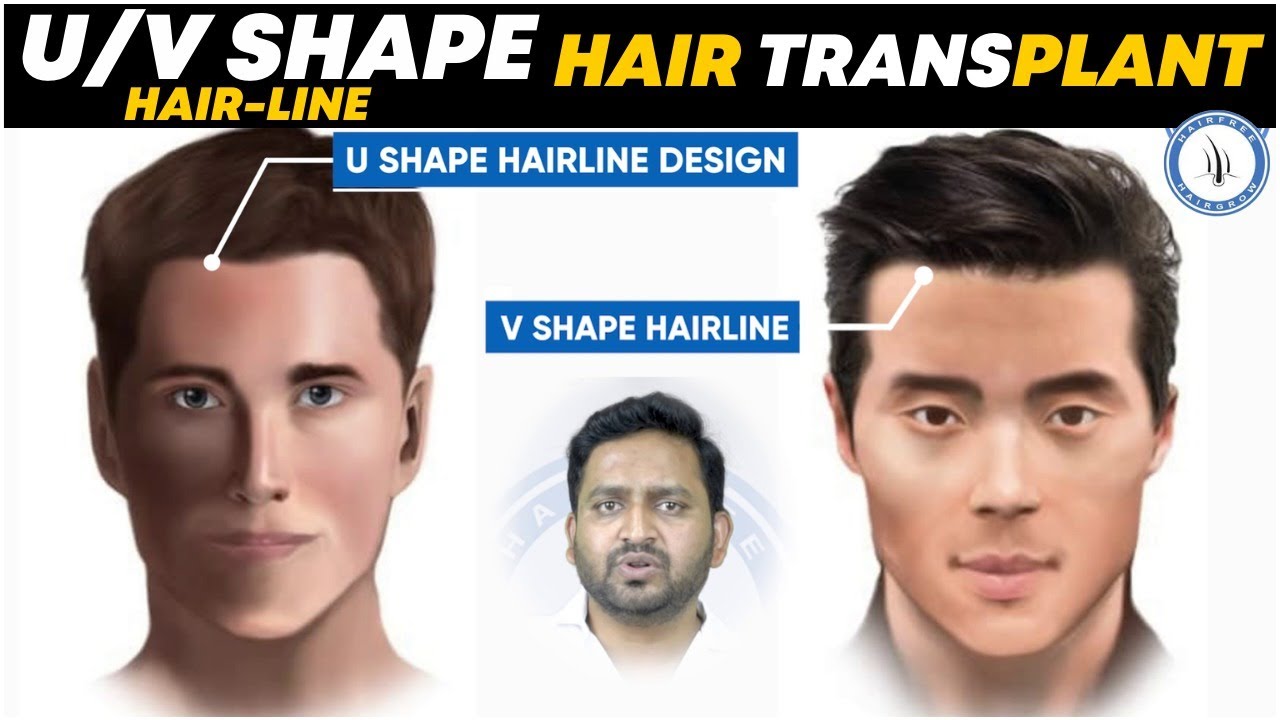 What is U/V SHAPED HAIR-LINE HAIR TRANSPLANT - By Dr. Nitin Maske ...