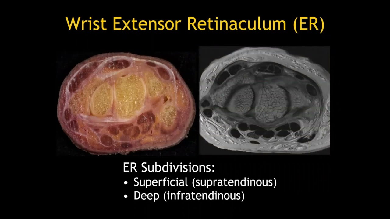 Extensor Retinaculum Wrist