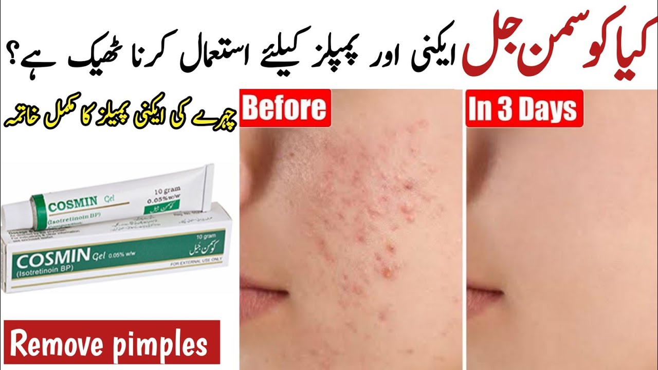 How to Remove Face Acne and Pimples at Home | Cosmin Gel review | Acne ...