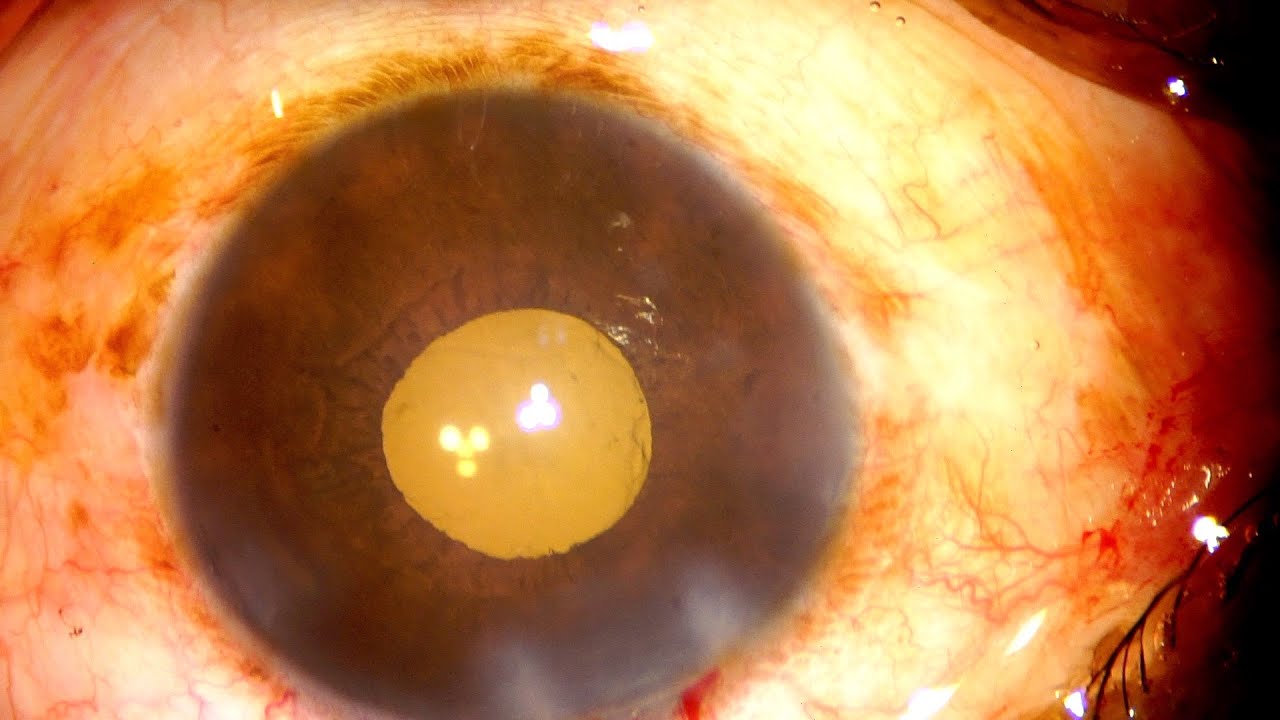 Small Pupil + Soft Cataract - Dr Ramakrishna Tadanki - YouTube