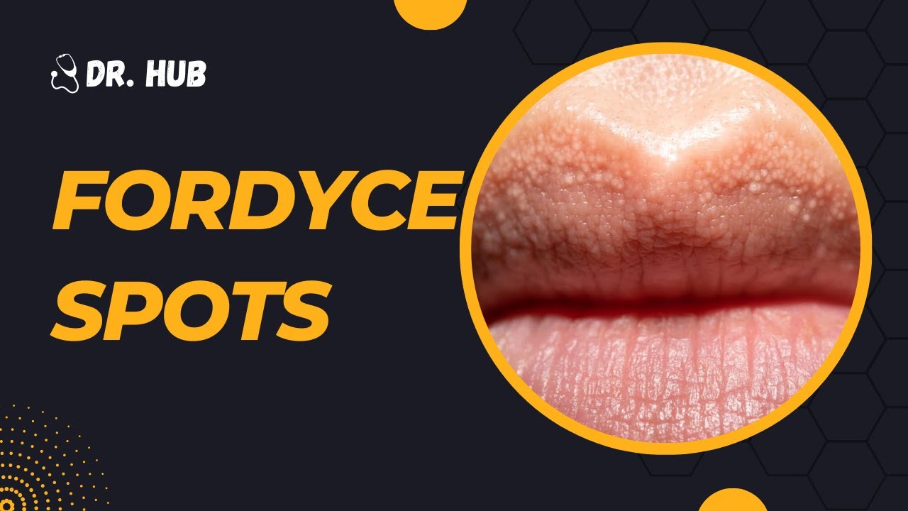 Fordyce Spots - YouTube
