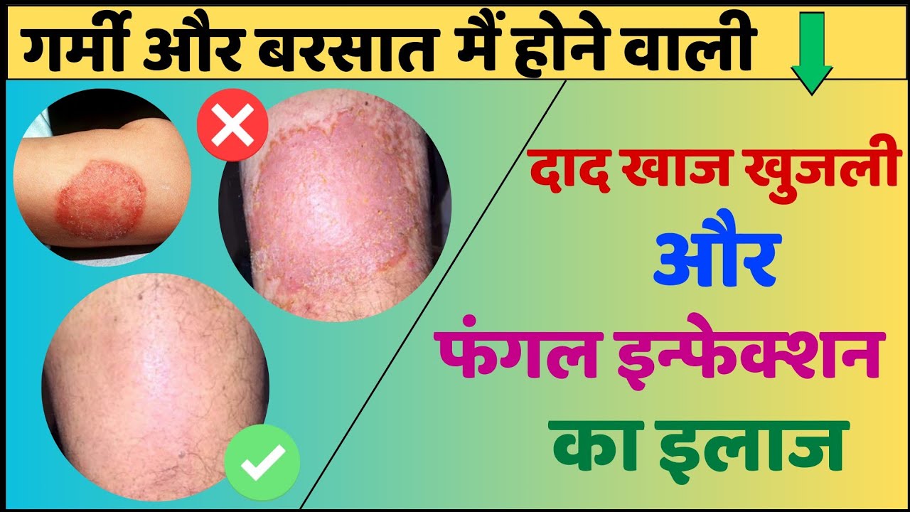 दाद खाज खुजली की दवा| Fungal Infection Treatment|Dad Khaj Aur Khujli ka ...