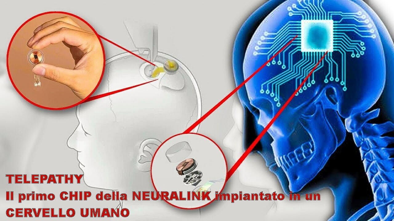 TELEPATHY – Il primo CHIP della NEURALINK impiantato in un CERVELLO ...