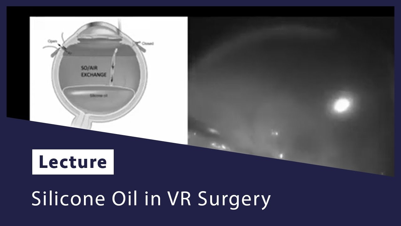Silicone Oil in VR Surgery - YouTube