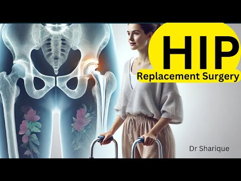 Uncemented Total hip replacement by Dr Mohd Sharique, Hip & knee ...