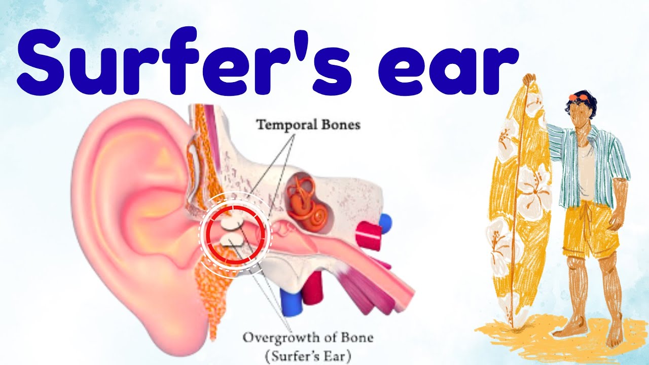 Surfer's ear (Bony growth inside Ear) - YouTube