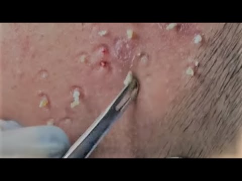 Solar Comedone Extractions Best Video - YouTube