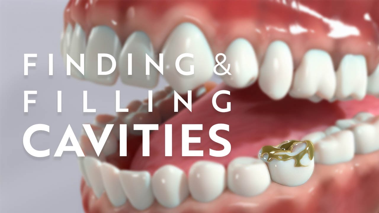 The process of finding and filling dental cavities - YouTube