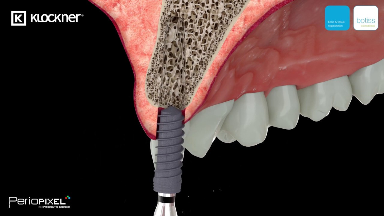 3D video Immediate soft and hard tissue alveolar reconstruction ...