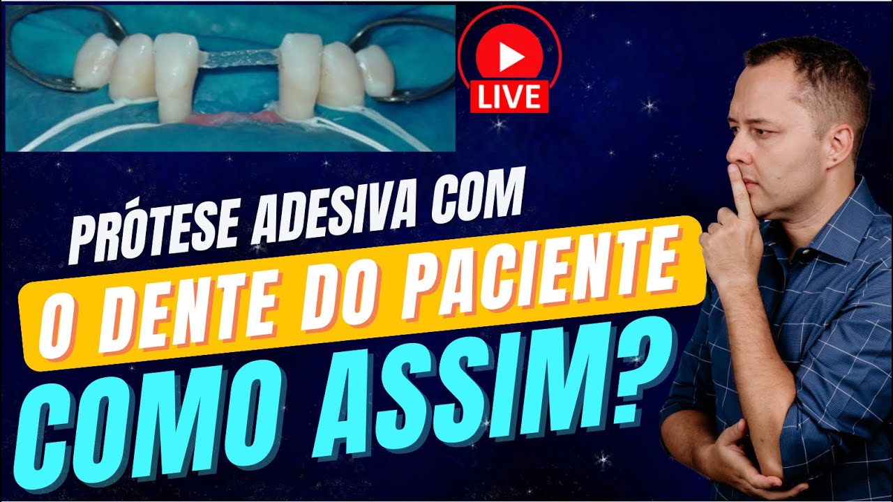 Prótese adesiva usando dentes do próprio paciente. - YouTube