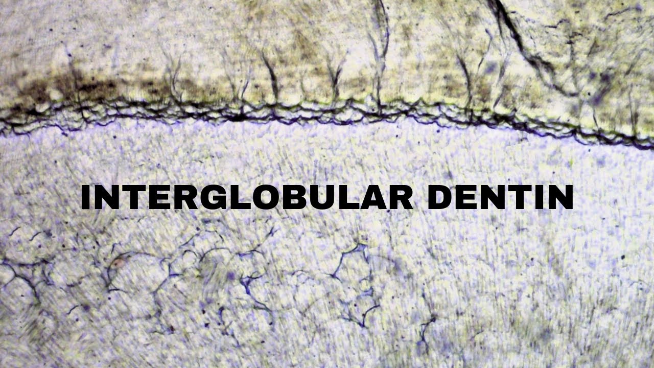 Interglobular dentin - Hypomineralized dentin - Dentistry, Oral ...