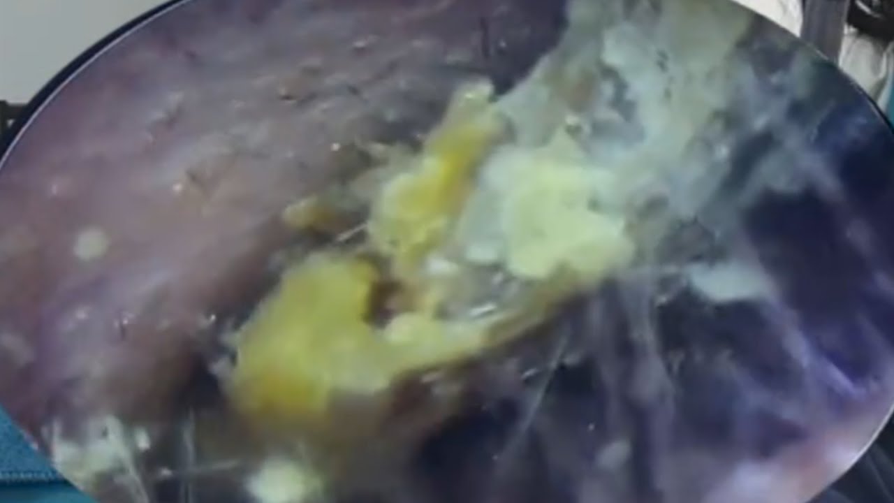 Removal of Hard Cerumen Balls and Thick Dry Tablets #earwax #Cleaning # ...