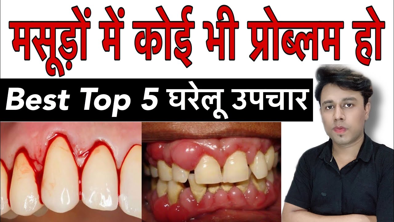 masudo ki problem ka gharelu upchar || मसूड़ों में सूजन का इलाज ...