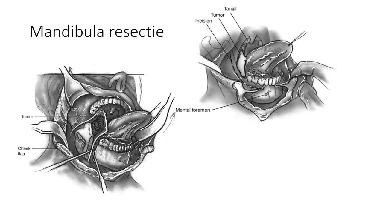 mondholte en orofarynx carcinoom - YouTube