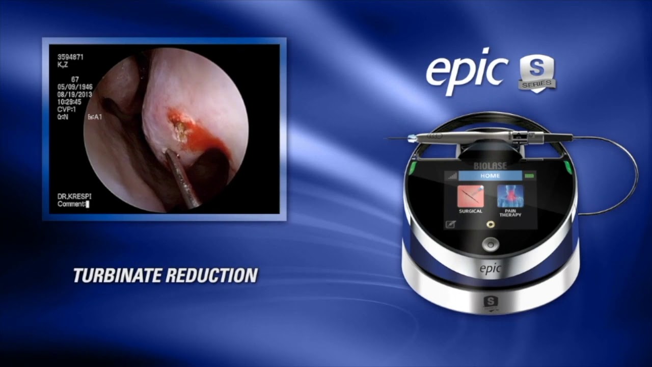 Ablation of nasal turbinates with Epic-S Diode laser - YouTube