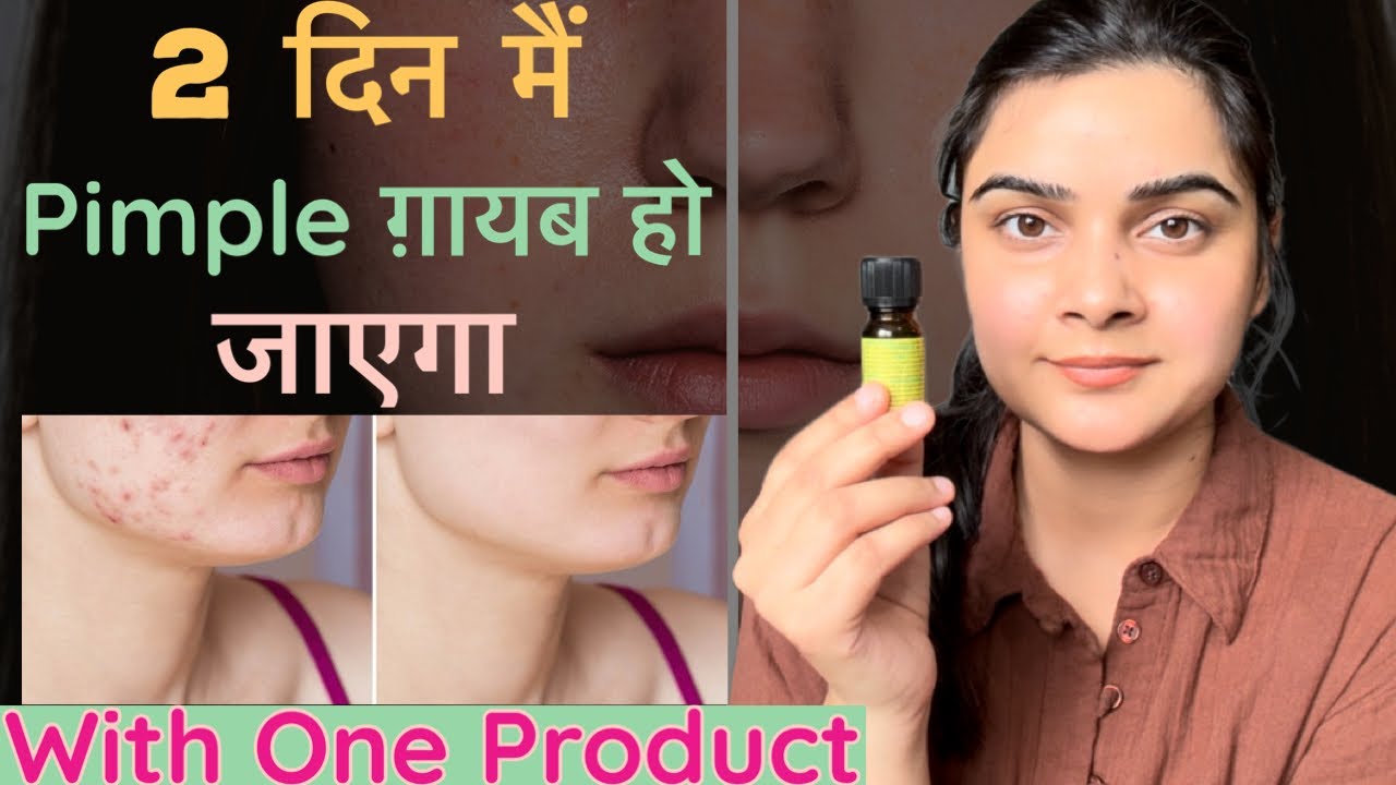 2 दिन मैं pimple बिलकुल ग़ायब हो जाएगा⭐️|| permanent solution for ...