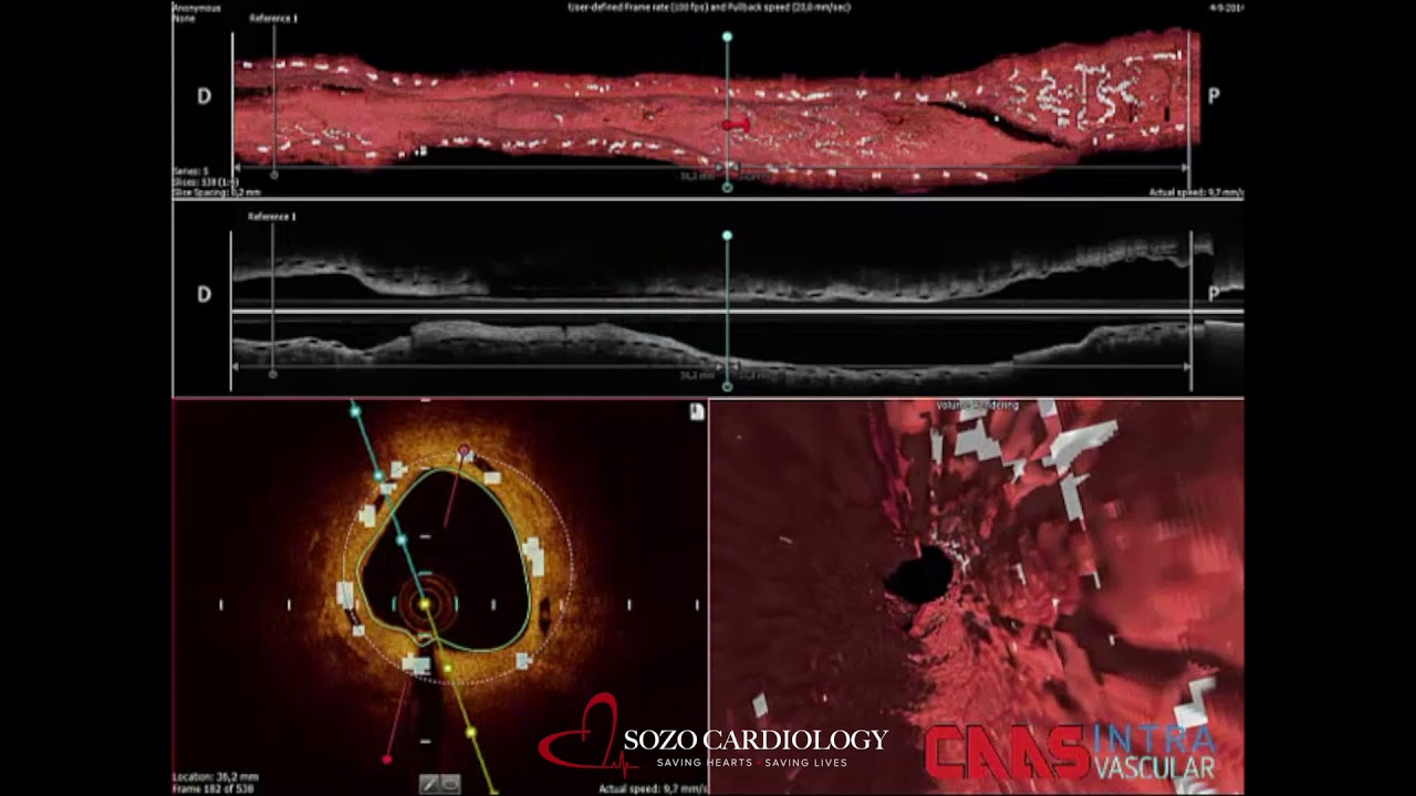 Optical Coherence Tomography (OCT) - YouTube