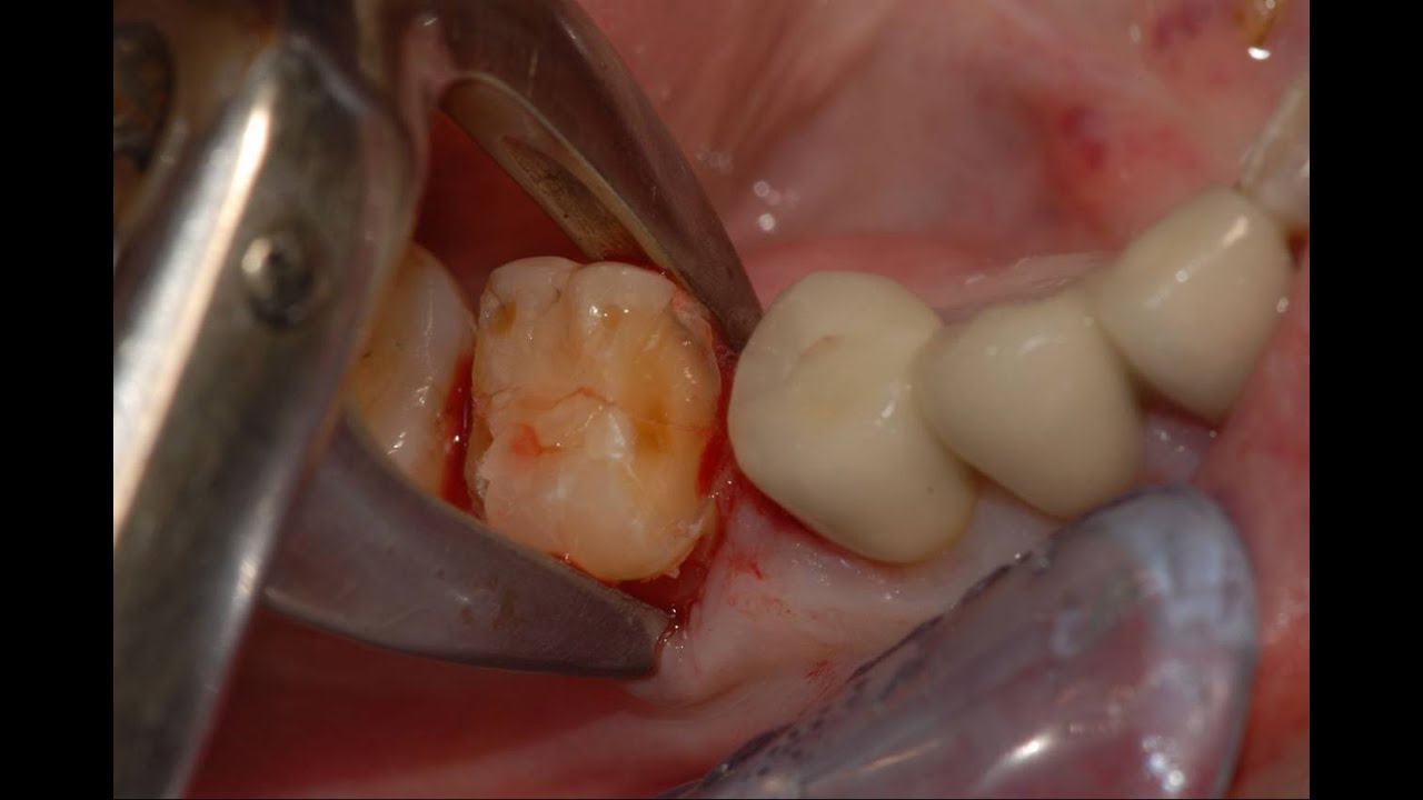Extracción Dental Atraumática. T 67 - YouTube