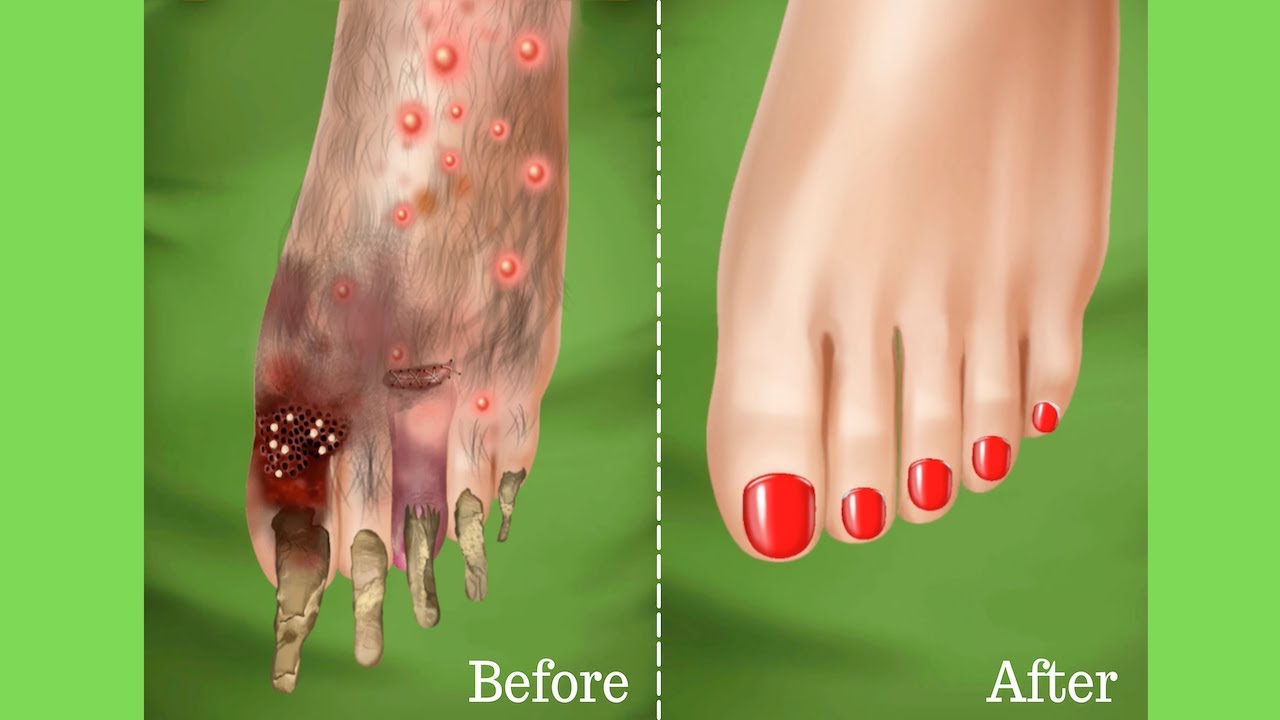 ASMR Foot Treatment Removal of Maggot Worms Insects and Bugs | #amsr # ...