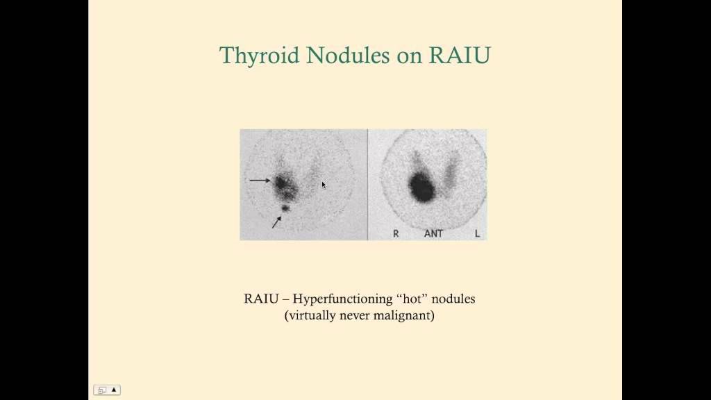 Thyroid Cancer - CRASH! Medical Review Series - YouTube