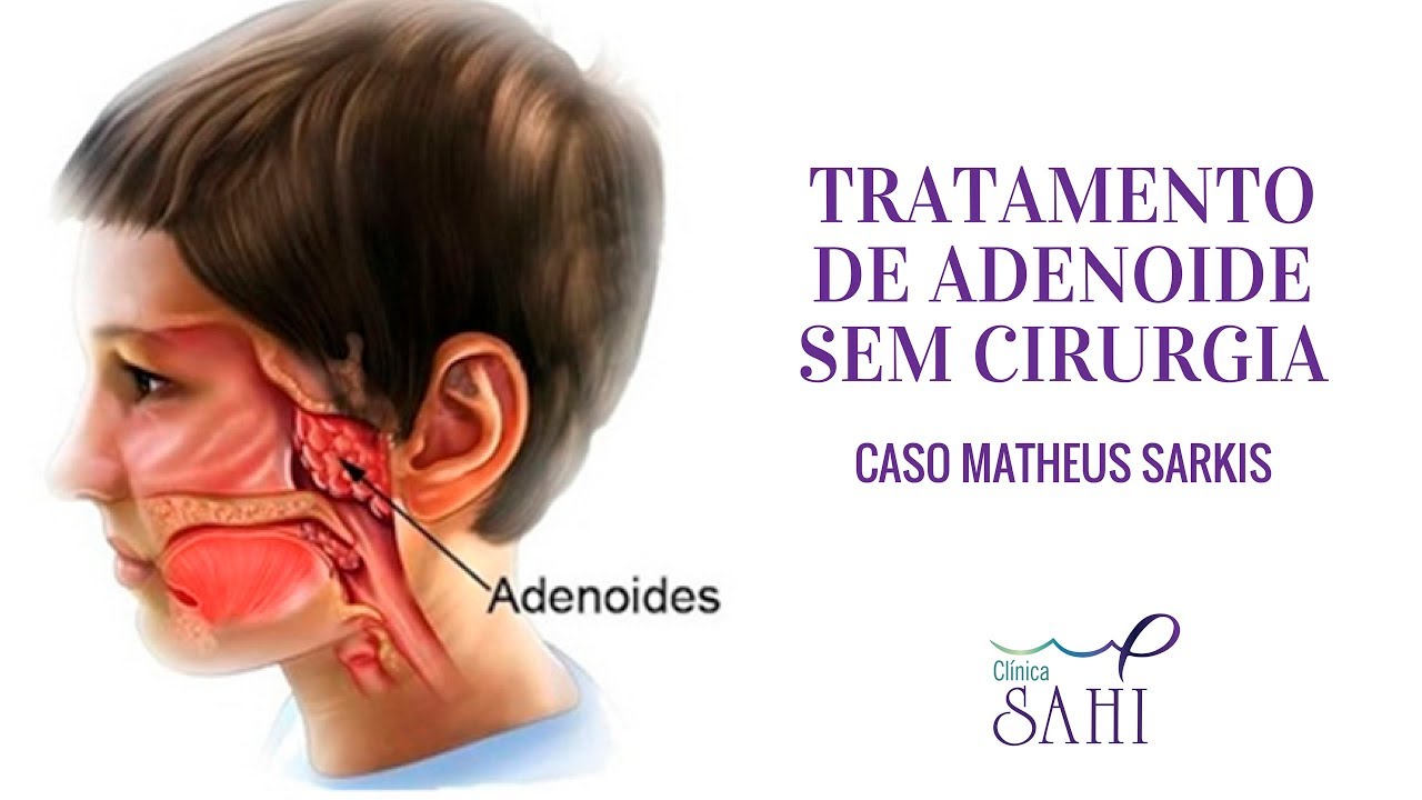 Tratamento de Adenoide sem Cirurgia - YouTube