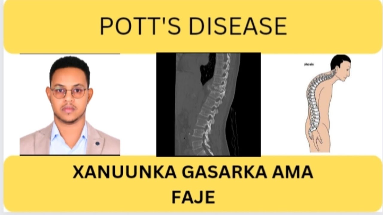 Wax ka ogow xanuunka " GASARKA " ( Pott's Disease ) Dr. Ayanle Ali ...