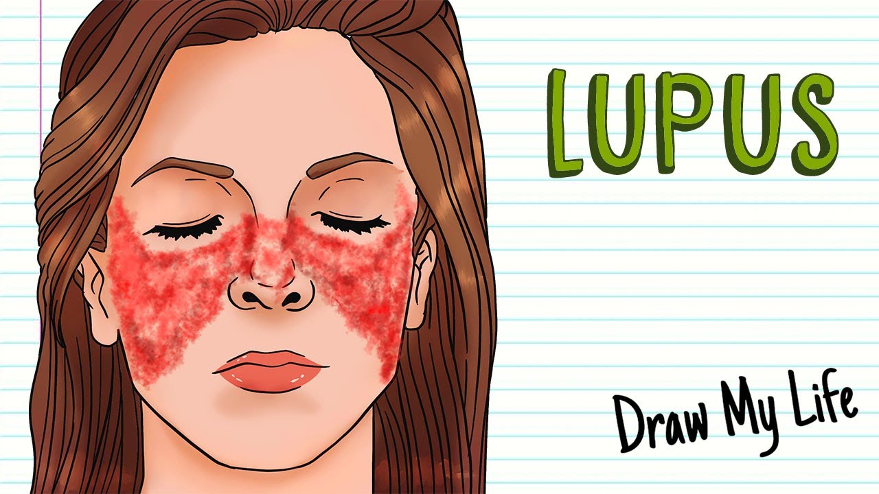 WHAT IS LUPUS? | Draw My Life - YouTube