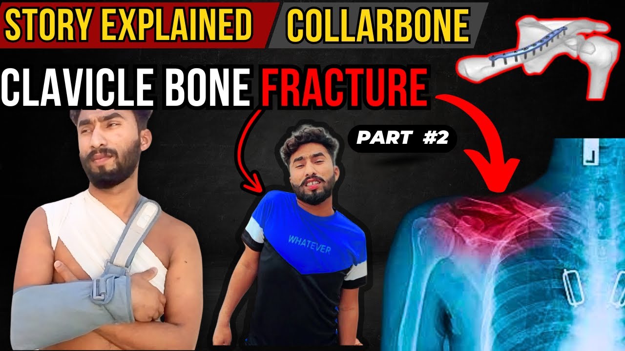 i broke my clavicle | collarbone fracture | clavicle fracture treatment ...