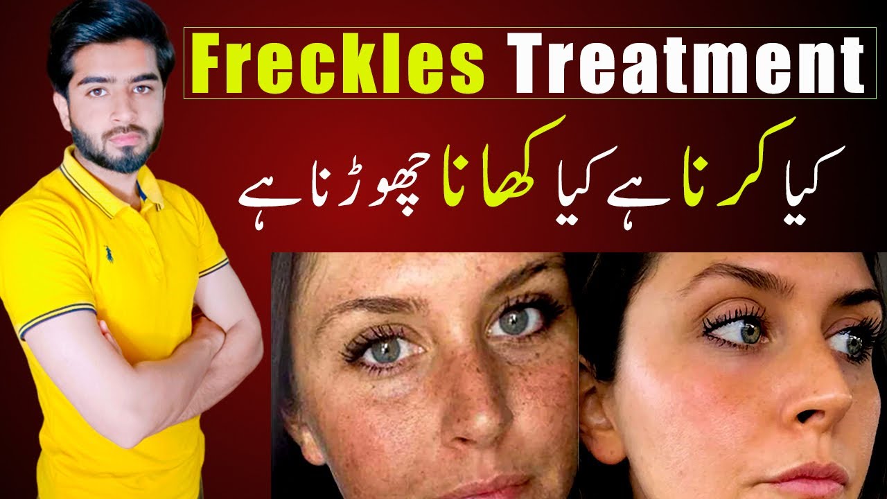 How To Remove Freckles 100% | Freckles Treatment At Home | What Causes ...