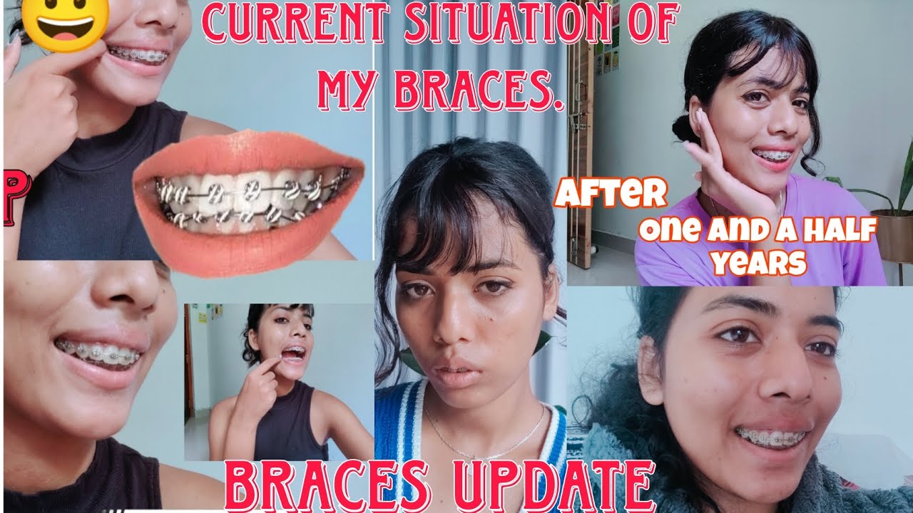 Braces update/Current situation of my Braces 🦷#bracesupdate # ...
