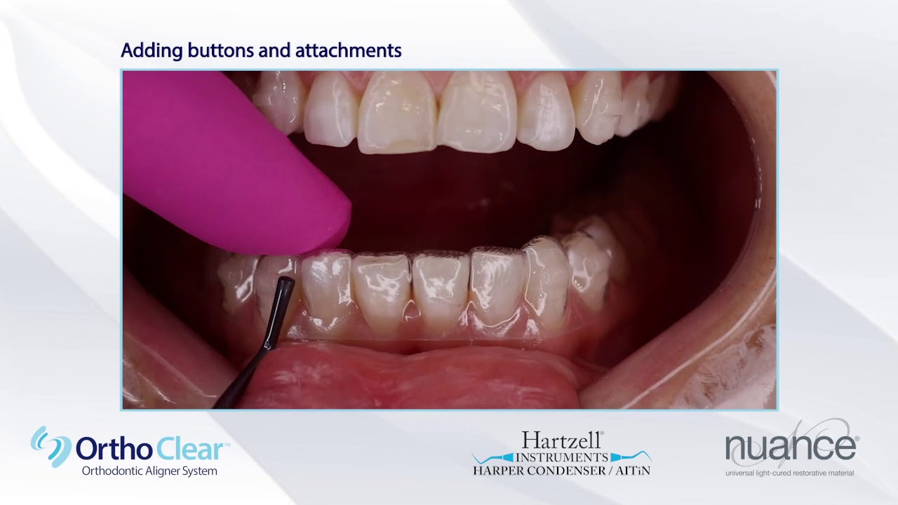 OrthoClear® Attachment - 30-Second Dentistry™ - YouTube
