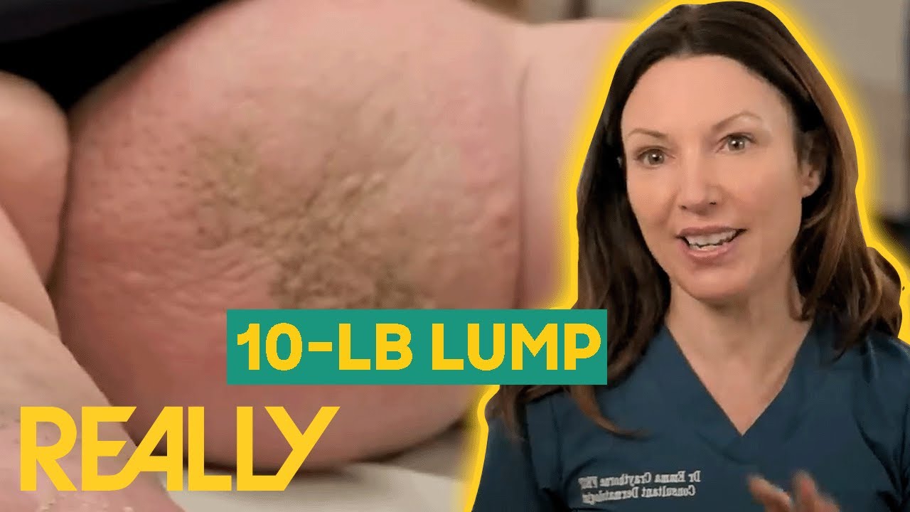 Dr. Emma Helps Patient With 10-lb Lump On Patient’s Leg | The Bad Skin ...
