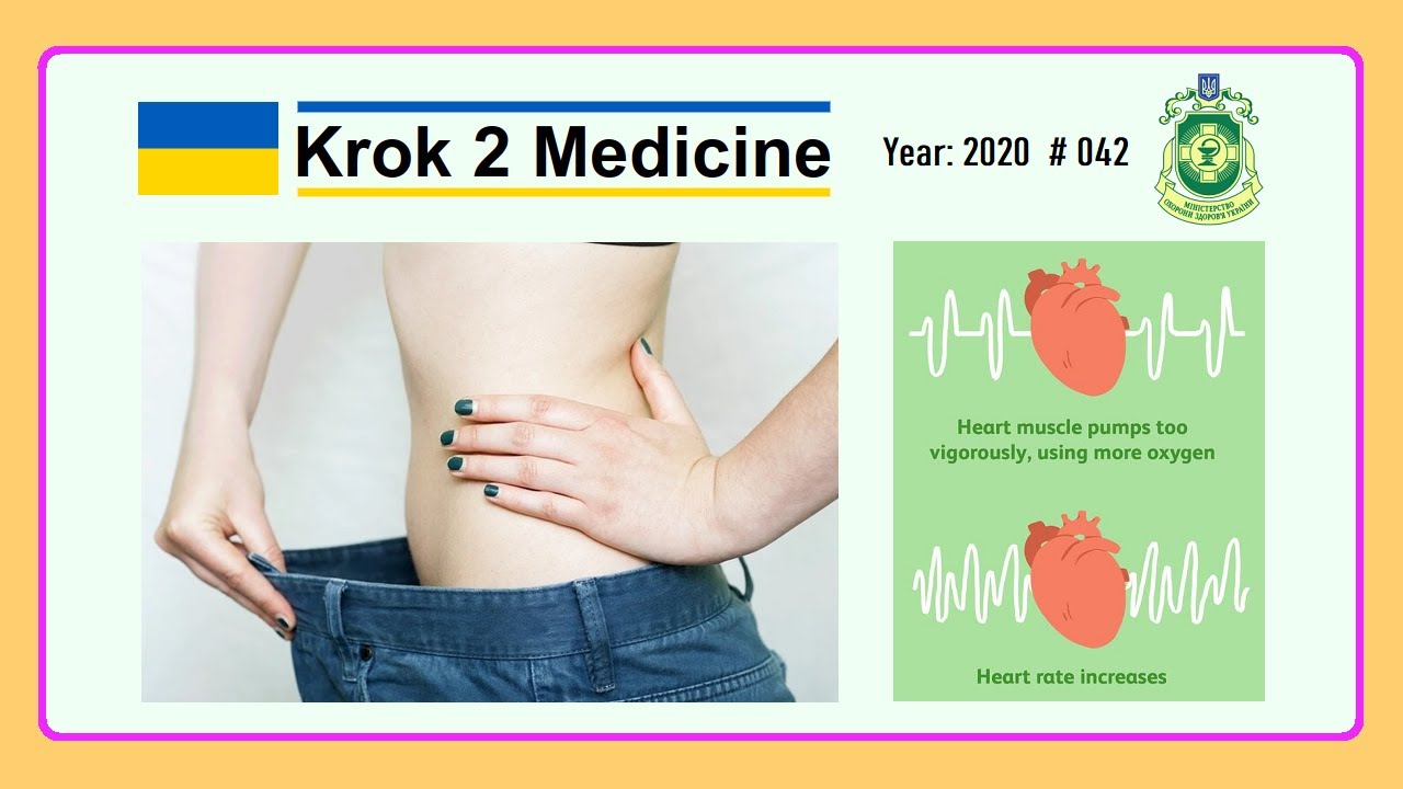 [ Krok 2 Medicine ] Year: 2020 - 042 (Ministry of Public Health of ...