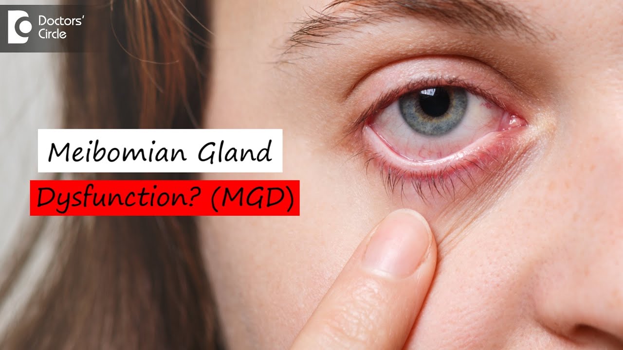 Meibomian Gland Dysfunction (MGD) & How it is corrected? - Dr. Sunita ...