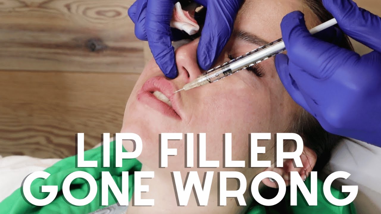 Rare Lip Filler Complication! - YouTube