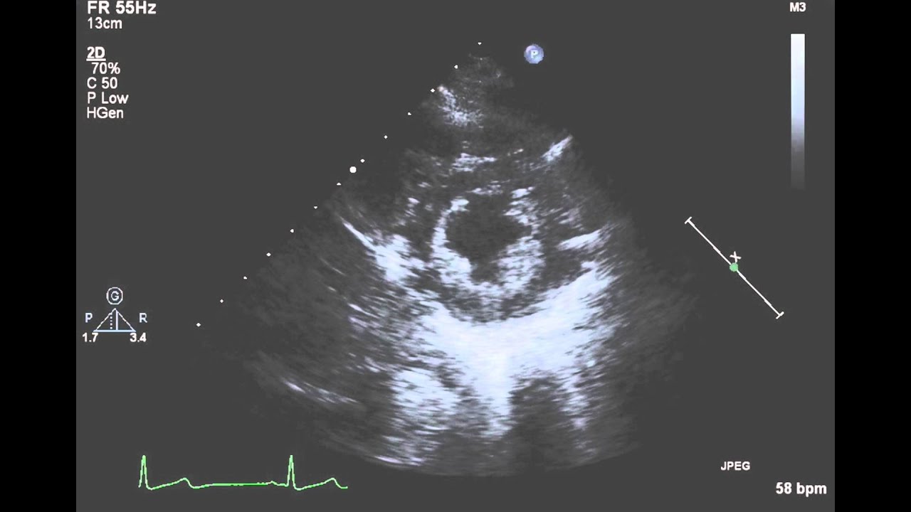 TTE Normal PSAX apex Example 1 - YouTube