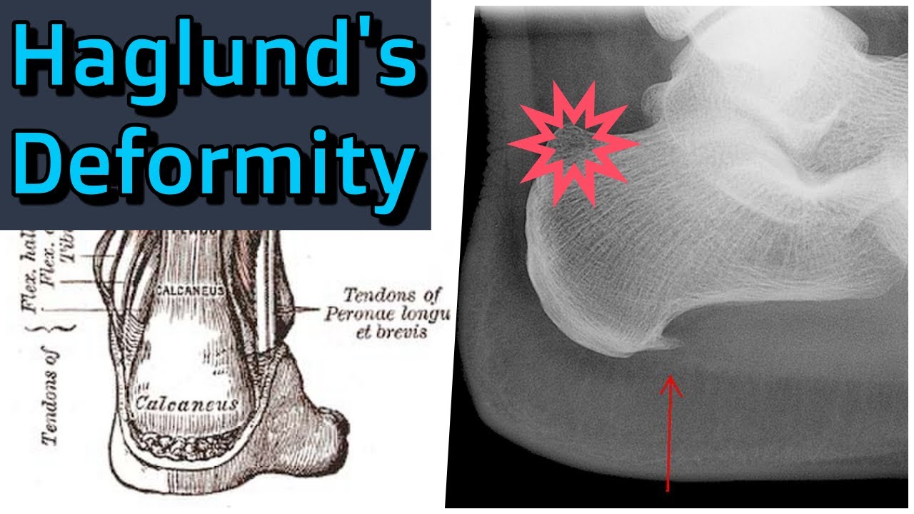 Haglund's Deformity - YouTube