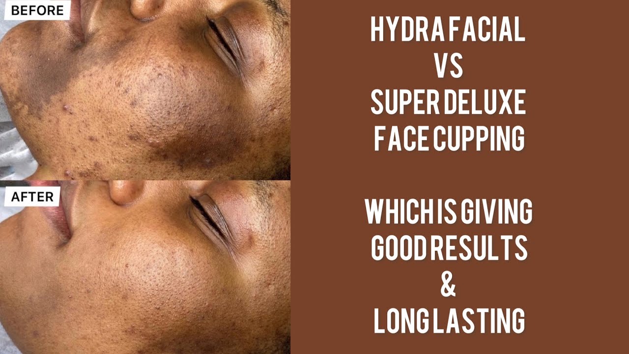 Hydra facial treatment vs super deluxe laser - YouTube