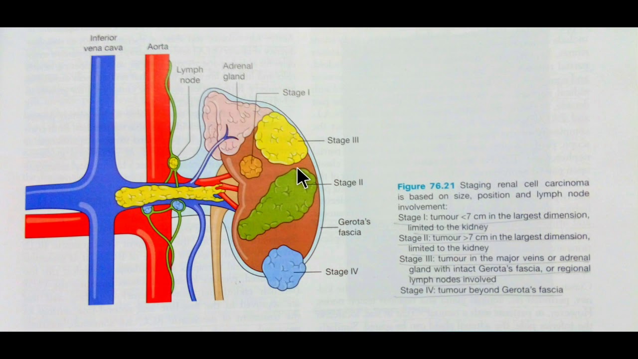 Renal cell carcinoma -staging and management - YouTube