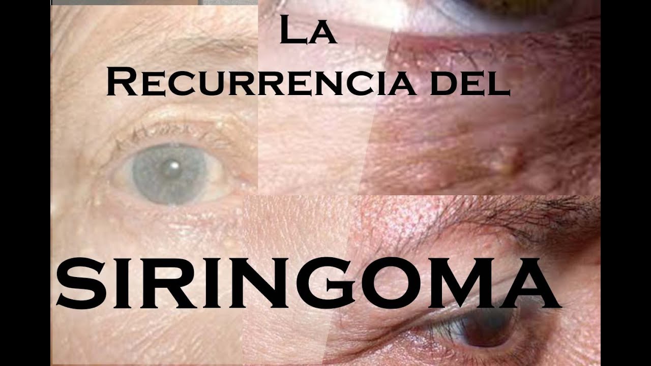 ¿POR QUÉ EL SIRINGOMA RECURRE FRECUENTE Y APARECE DONDE YA SE HABÍA ...
