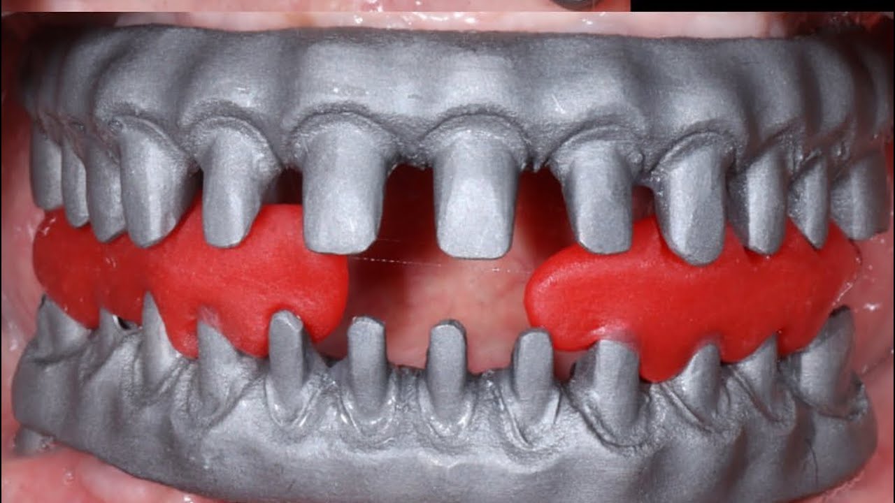 Full Mouth Dental Implants Occlusion | Dentist Delhi | Full Mouth ...