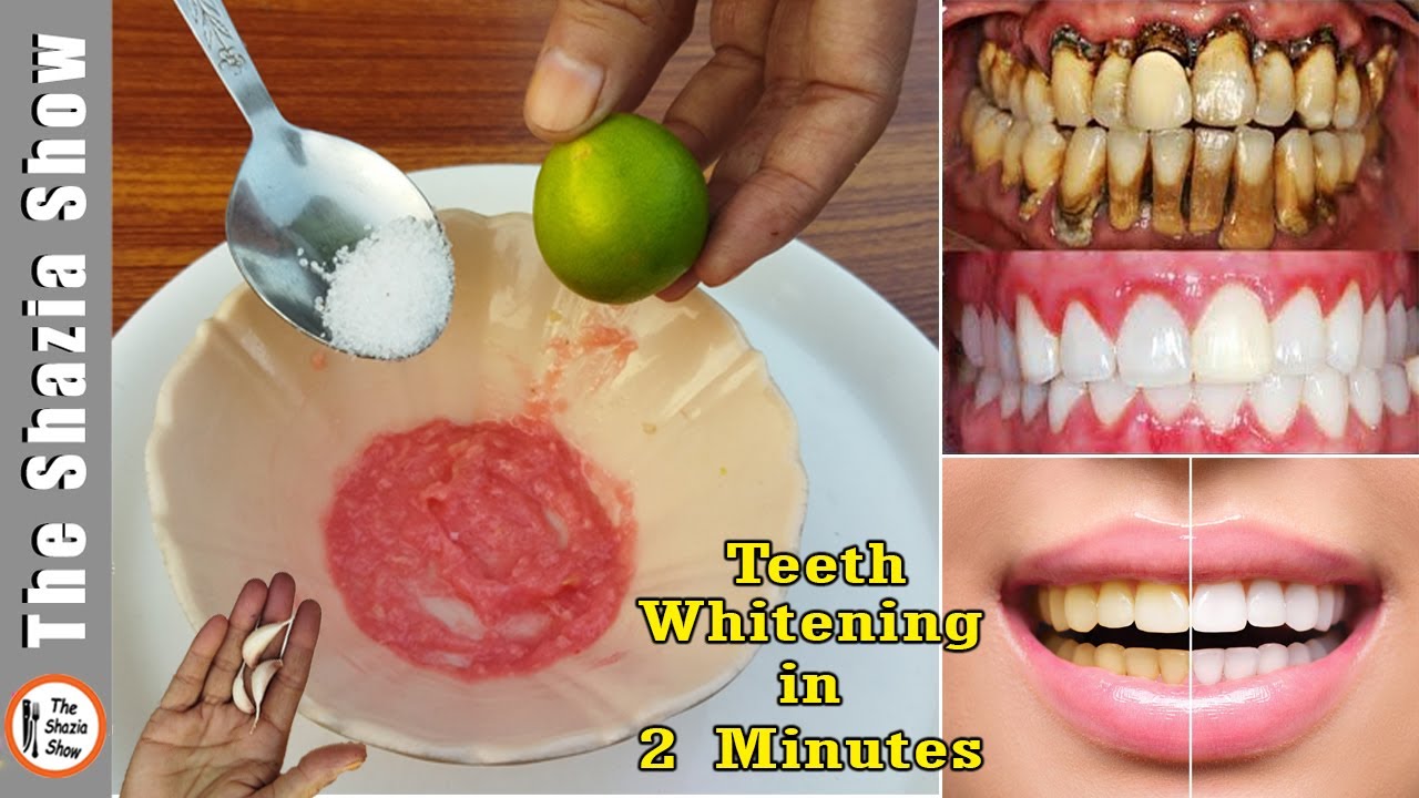 Teeth Whitening At Home In 2 Minutes How To Whiten Your Yellow Teeth