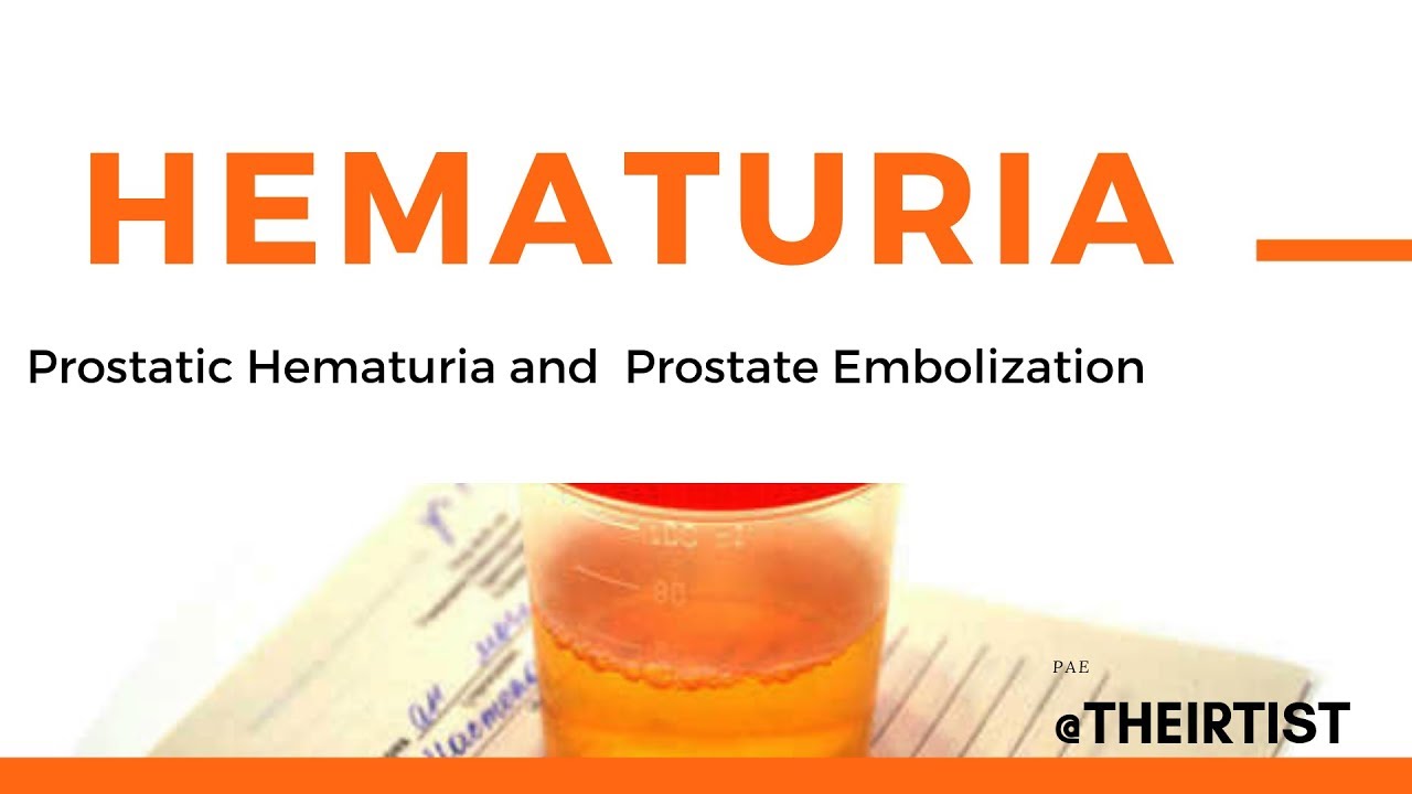 Prostate Hematuria ( Blood in urine) and PAE ( prostate artery ...