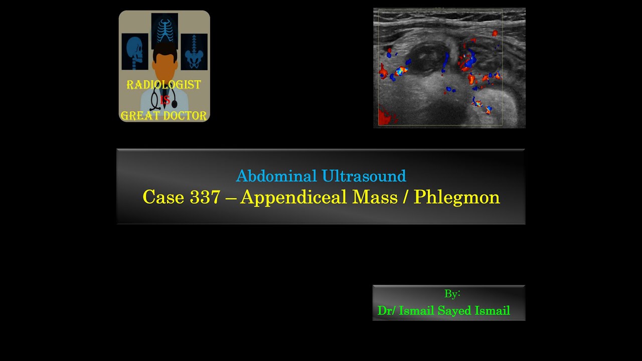 Ultrasound Case 337 - Appendiceal Mass / Phlegmon - YouTube